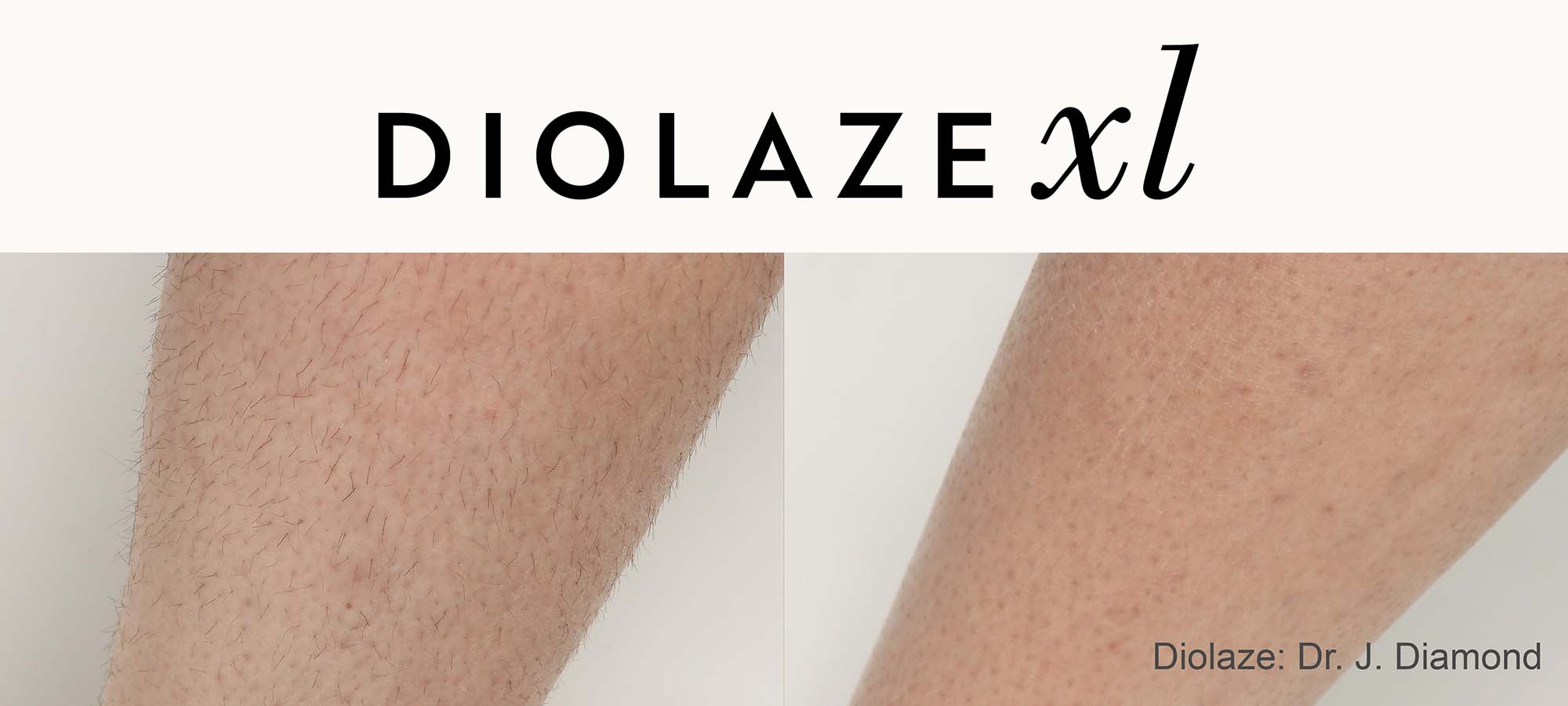 InMode Optimas - Artemis | Esthetics + Wellness