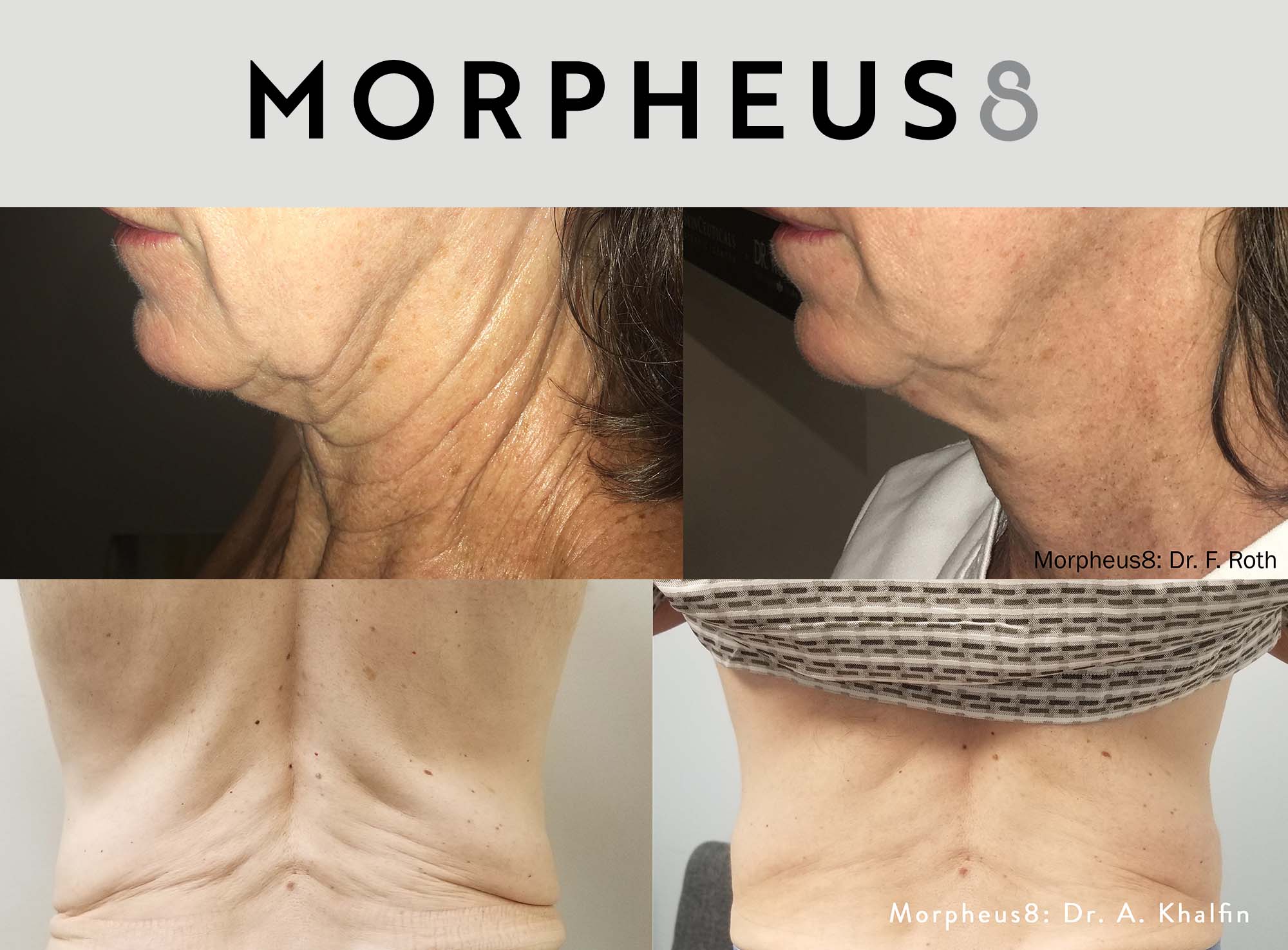 InMode Optimas - Artemis | Esthetics + Wellness